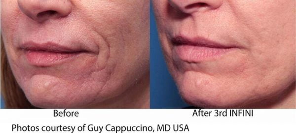 INFINI Skin Rejuvenation Laser Treatment | Santa Monica | Los Angeles ...